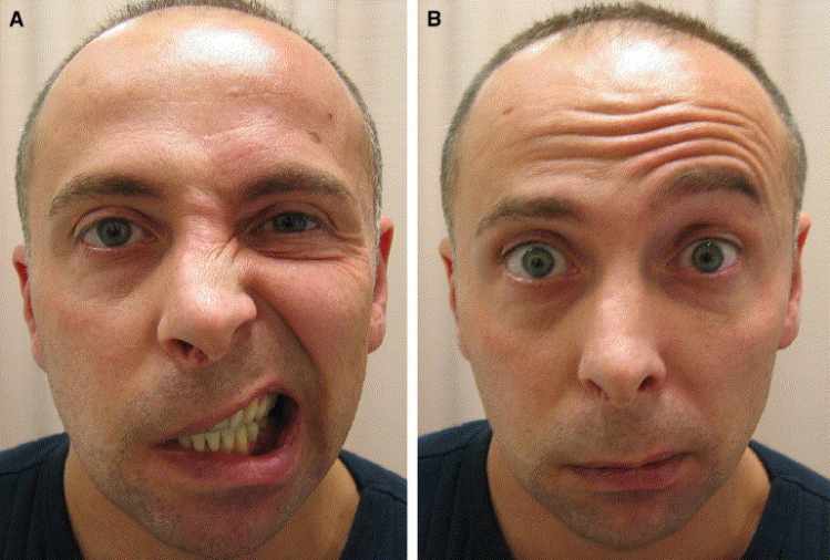 Facial nerve palsy – AL-Salem Eye Clinic