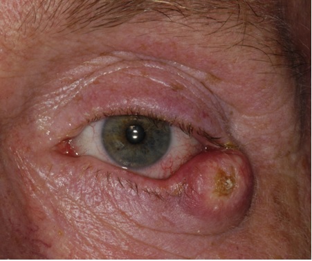 Benign Lesions of the eyelid – AL-Salem Eye Clinic