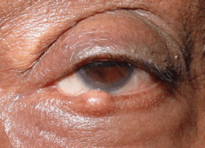Benign Lesions of the eyelid – AL-Salem Eye Clinic