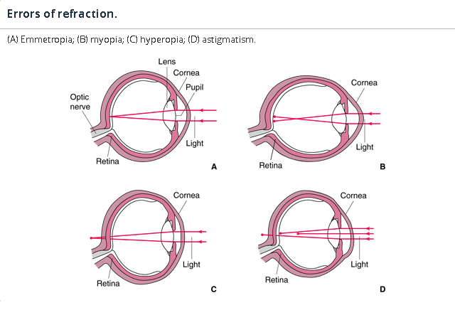 principles of refractive errors – AL-Salem Eye Clinic