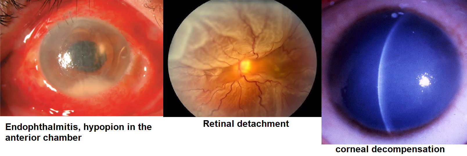 CATARACT SURGERY – AL-Salem Eye Clinic