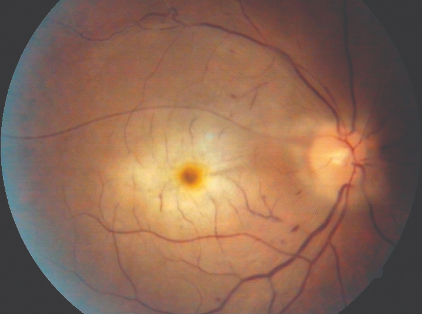 Retina vascular disease 3 – AL-Salem Eye Clinic