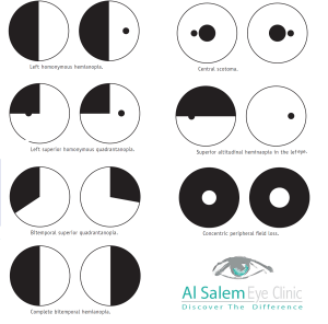 Neuro-ophthalmology 2 – AL-Salem Eye Clinic