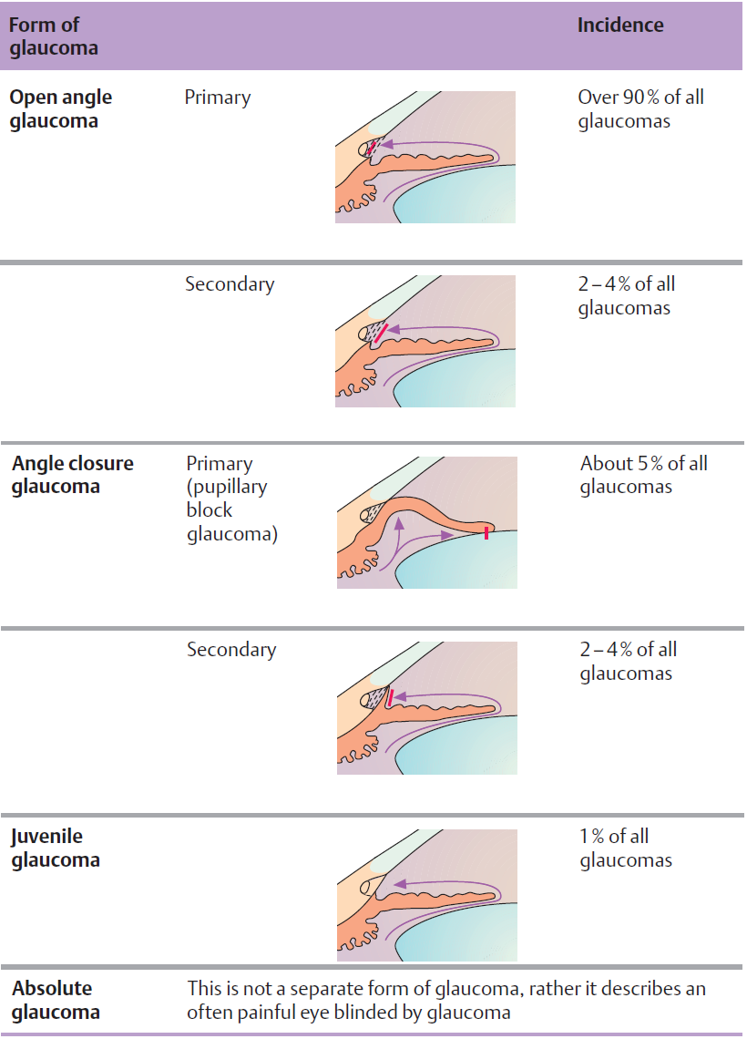 Glaucoma – AL-Salem Eye Clinic