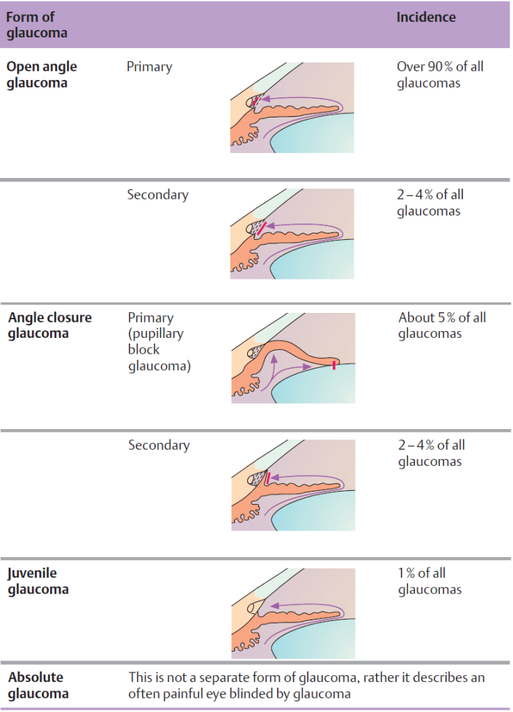 Glaucoma – AL-Salem Eye Clinic